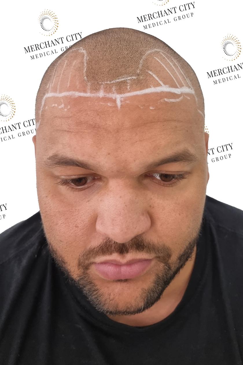 Hair Transplants Models - Merchant City Medical Group