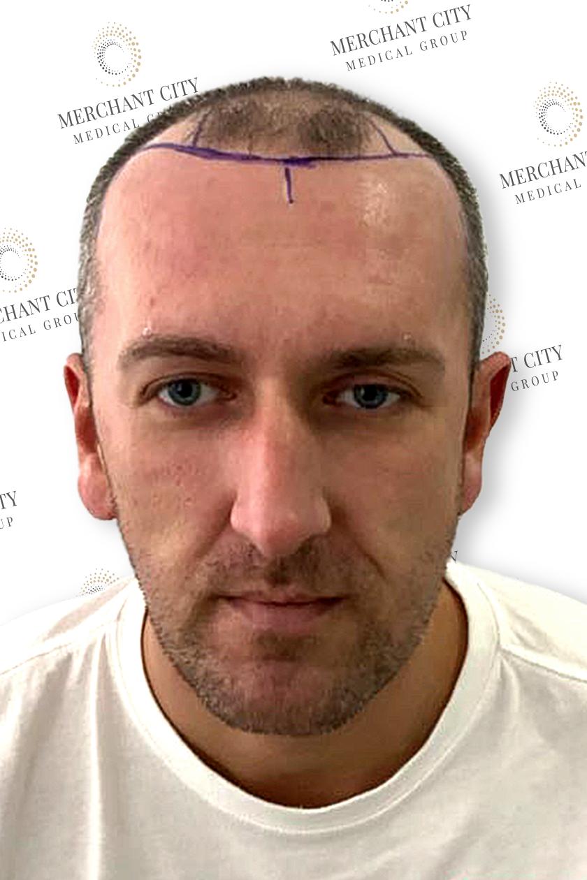 Hair Transplants Models - Merchant City Medical Group