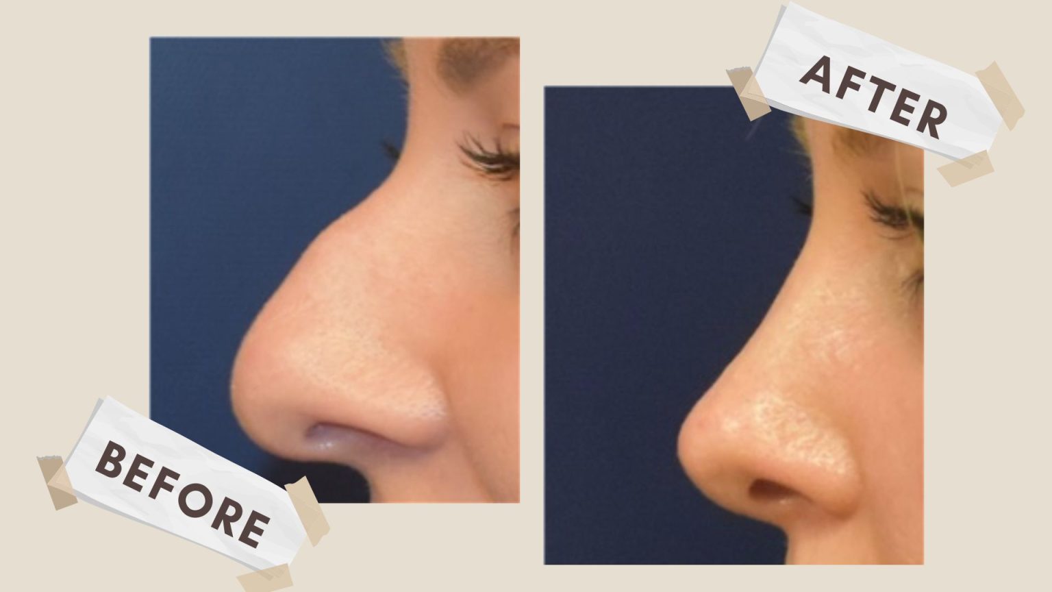 Rhinoplasty nasal reconstruction plastic surgery free consultation ...