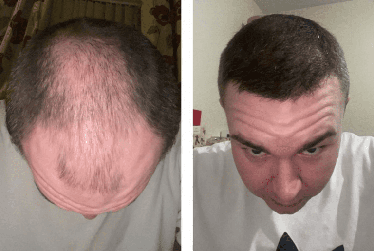 FUE vs. FUT: Deciding the Right Hair Transplant Method for You ...